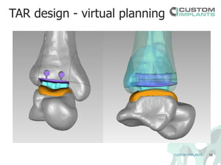 Custom endoprotesi - Design of patient specific ankle prosthesis for ...
