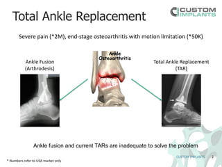 Custom endoprotesi - Design of patient specific ankle prosthesis for ...