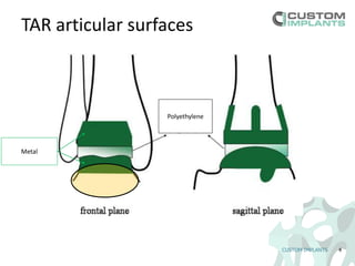 Custom endoprotesi - Design of patient specific ankle prosthesis for ...