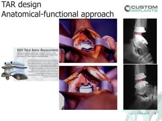 Custom endoprotesi - Design of patient specific ankle prosthesis for ...