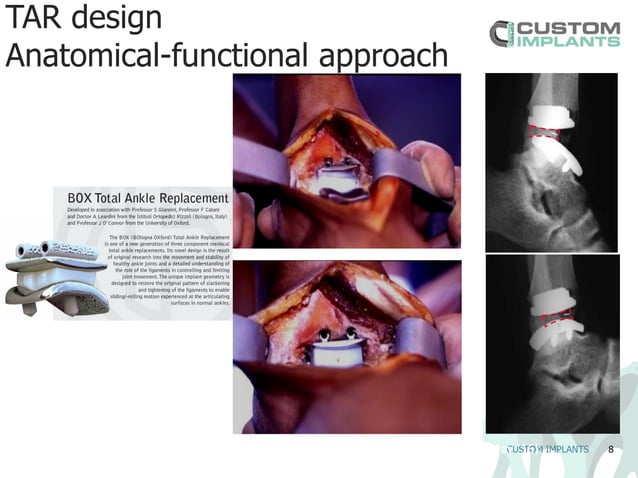 Custom endoprotesi - Design of patient specific ankle prosthesis for ...