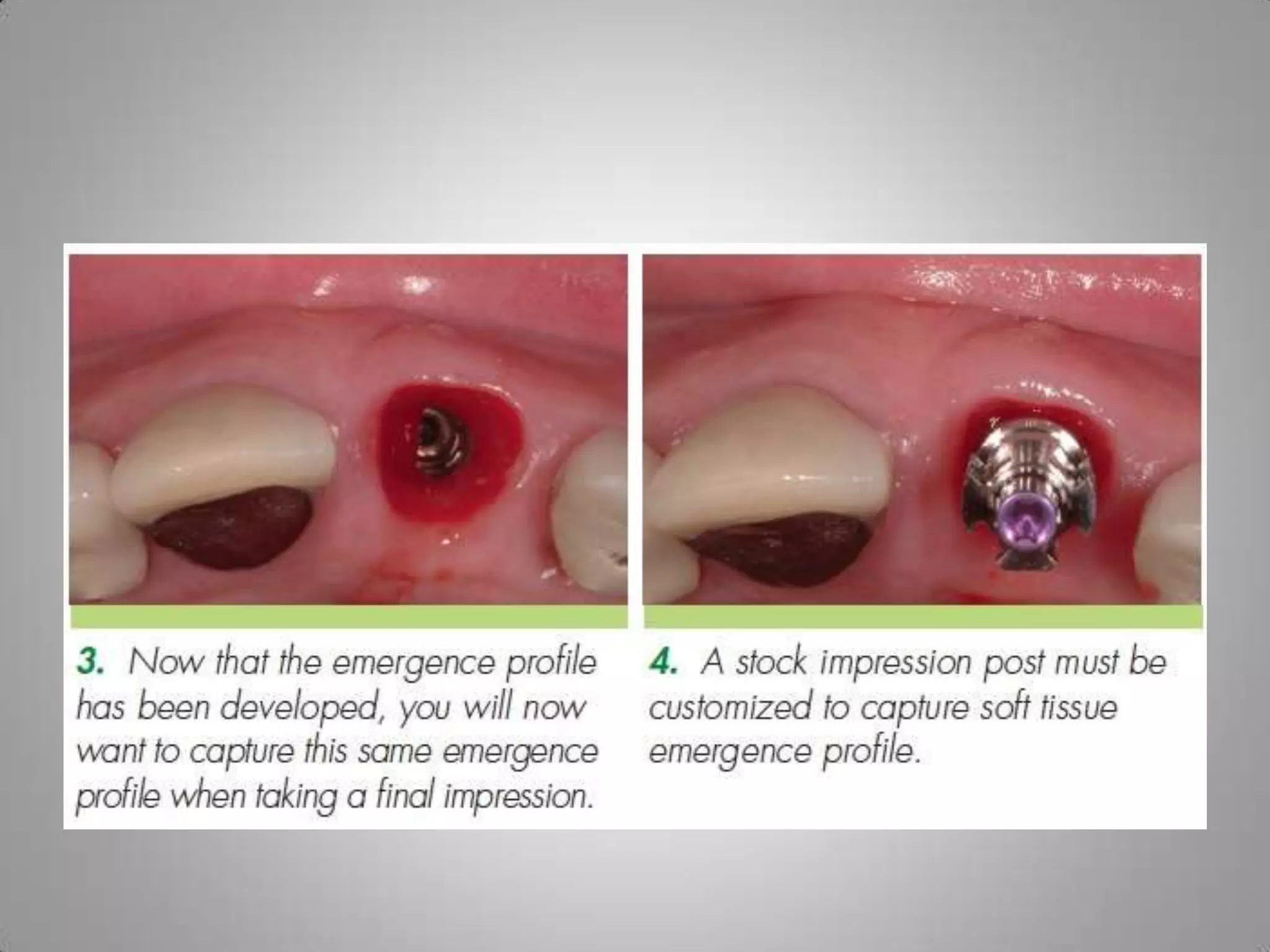 Customized Dental Implant Impression Post Technique | PPTX