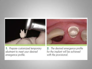 Customized Dental Implant Impression Post Technique | PPTX