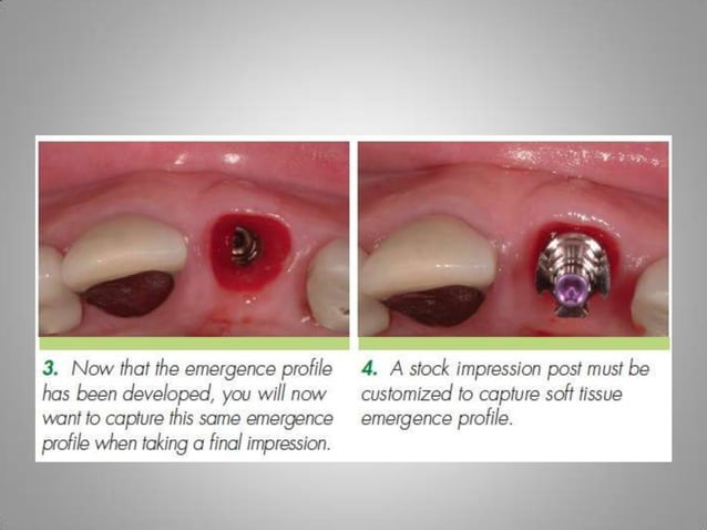 Customized Dental Implant Impression Post Technique | PPTX | Dental ...