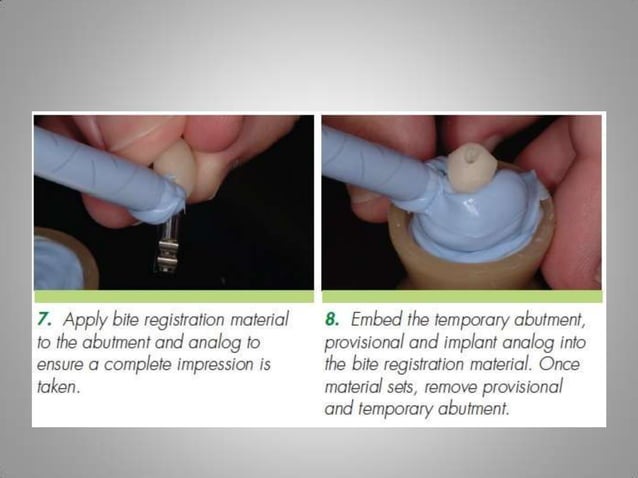 Customized Dental Implant Impression Post Technique | PPTX | Dental ...