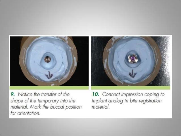 Customized Dental Implant Impression Post Technique | PPTX | Dental ...