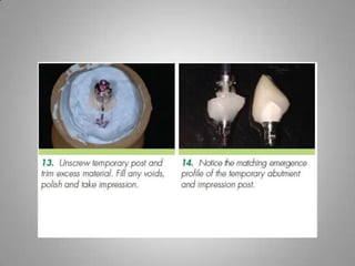 Customized Dental Implant Impression Post Technique | PPTX