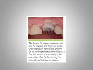 Customized Dental Implant Impression Post Technique | PPTX