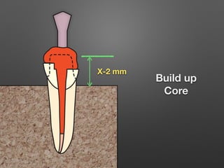 Custom post & core ( lab procedure) | PPT