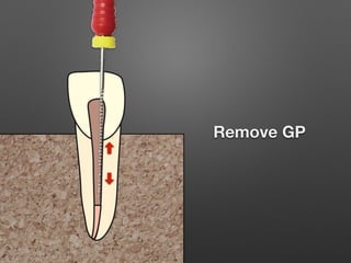Custom post & core ( lab procedure) | PDF