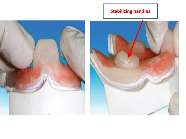 custom tray.pptx | Oral care | Personal Care