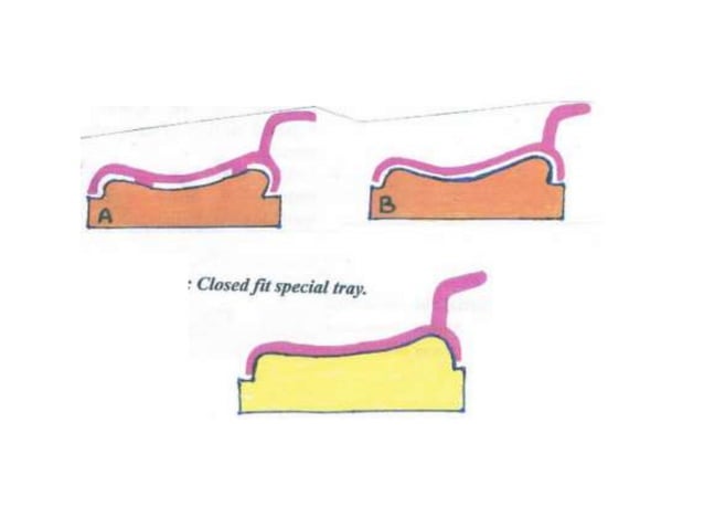 custom tray.pptx | Oral care | Personal Care