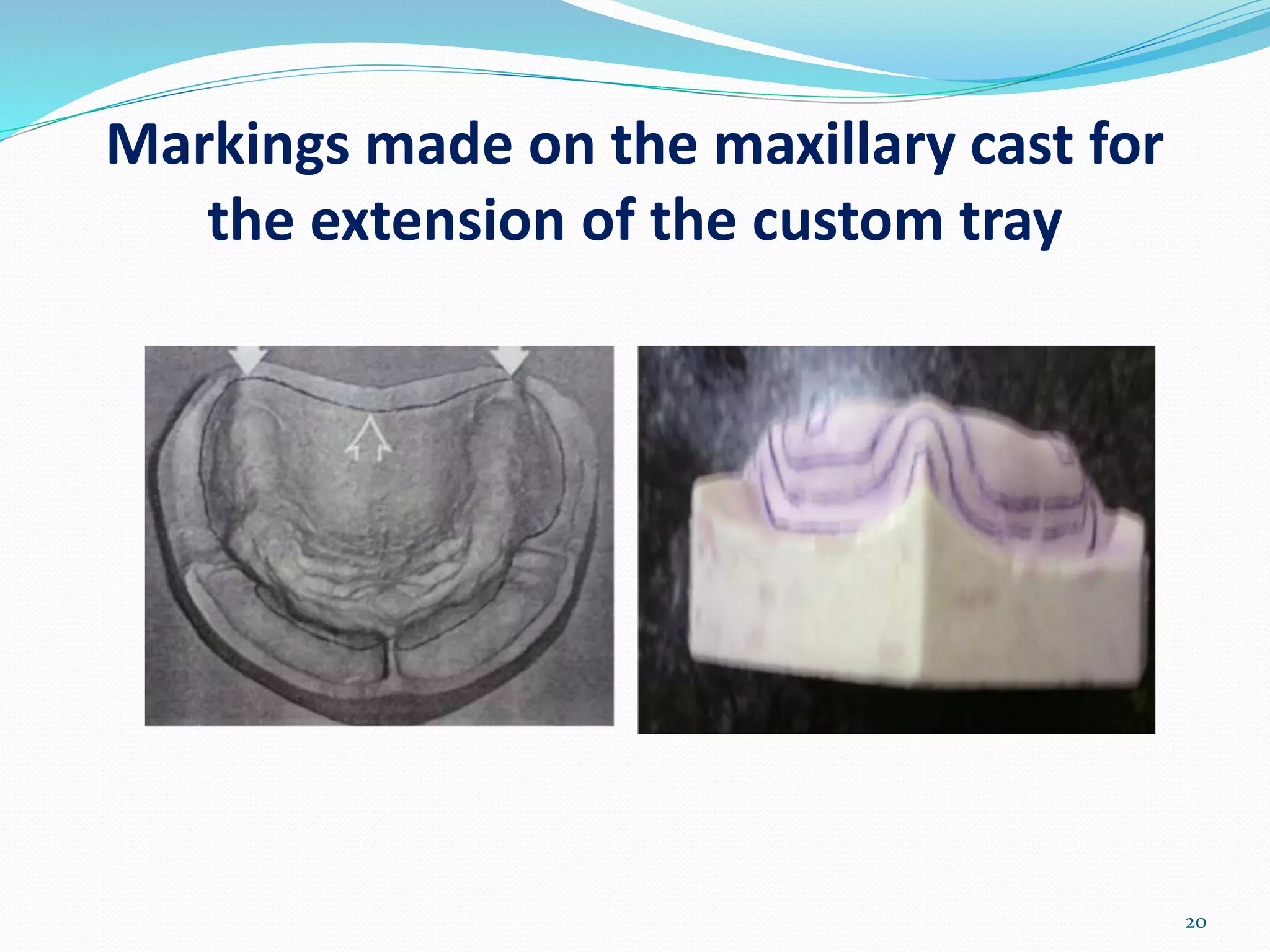 CUSTOM TRAYS AND SPACER DESIGNS.pptx