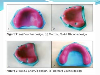 CUSTOM TRAYS AND SPACER DESIGNS.pptx