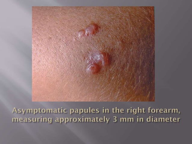 Cutaneous pseudolymphoma
