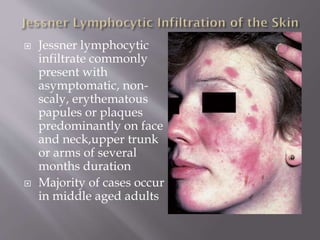 Jessner Lymphocytic Infiltrate