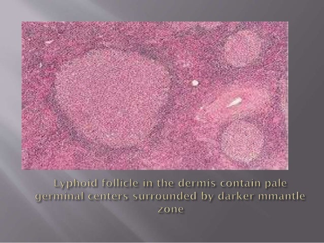 Cutaneous pseudolymphoma