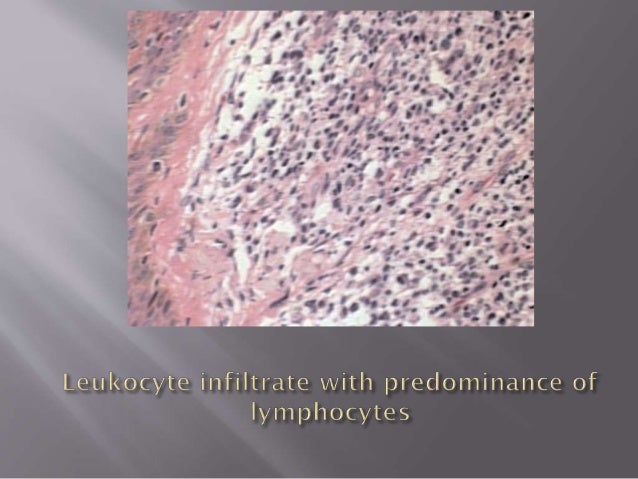 Cutaneous pseudolymphoma