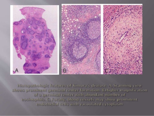 Cutaneous pseudolymphoma