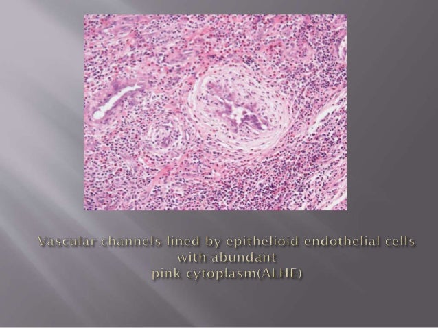 Cutaneous pseudolymphoma