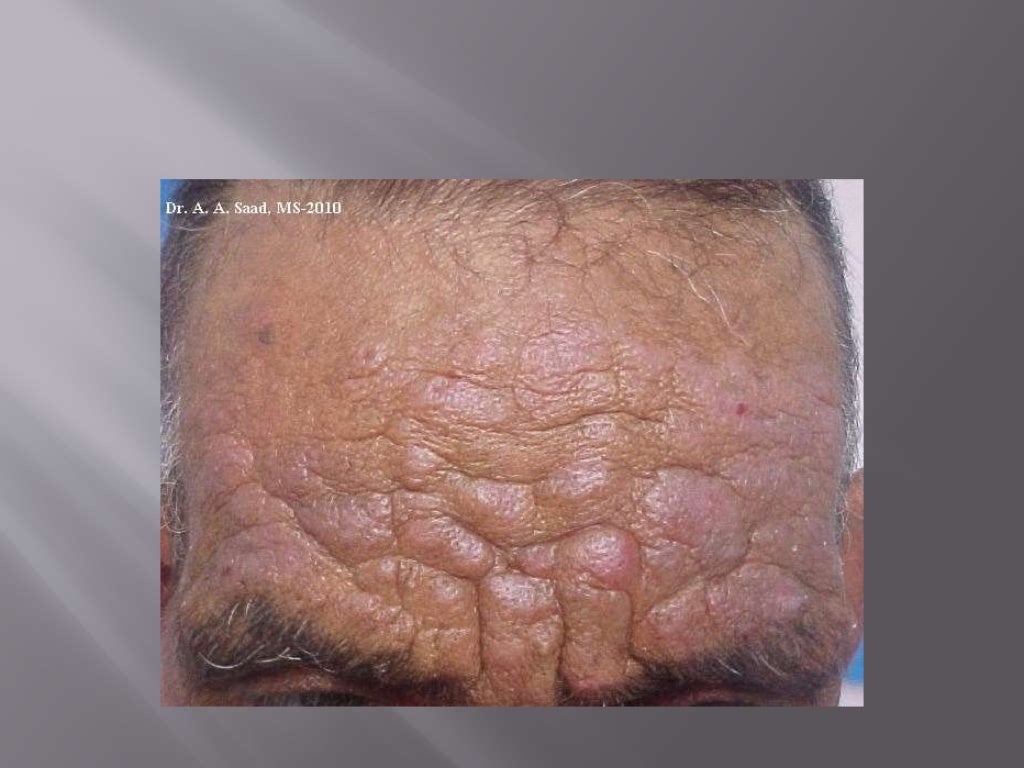 Cutaneous pseudolymphoma