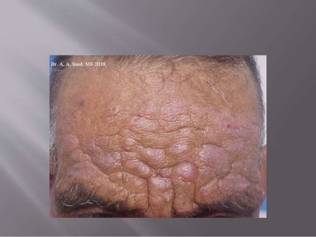 Cutaneous pseudolymphoma