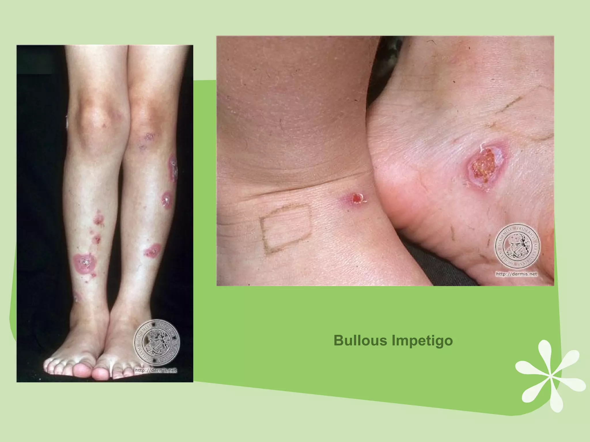 Cutaneous Bacterial Infections | PPT
