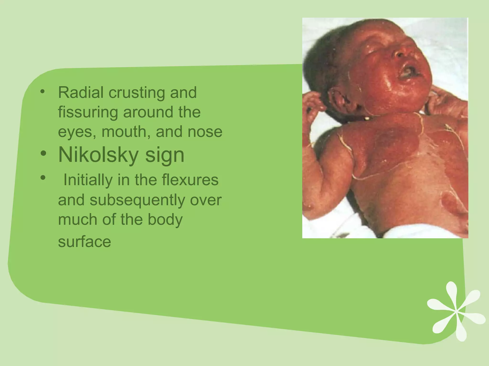 Cutaneous Bacterial Infections | PPT