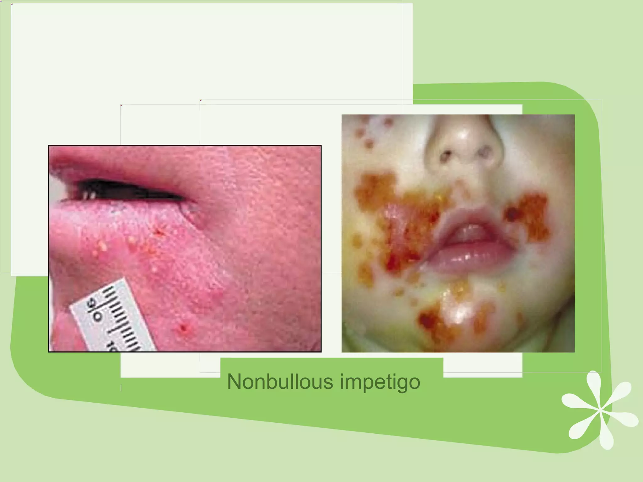 Cutaneous Bacterial Infections | PPT