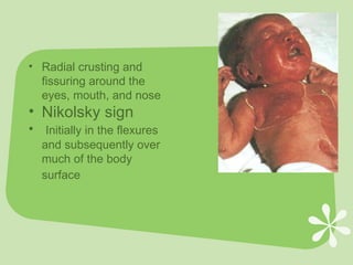 Cutaneous Bacterial Infections | PPT