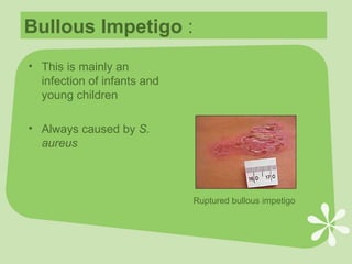 Cutaneous Bacterial Infections | PPT