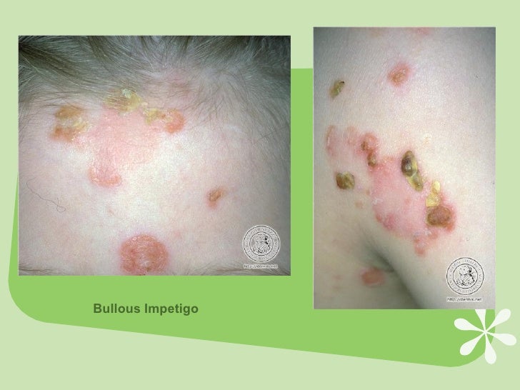 Cutaneous Bacterial Infections