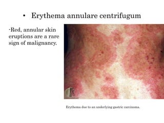 Cutaneous presentation of tumours | PPTX