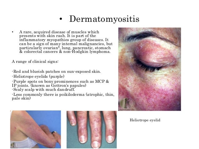 Cutaneous presentation of tumours