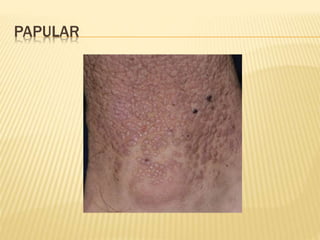 Cutaneous amyloidosis | PPTX