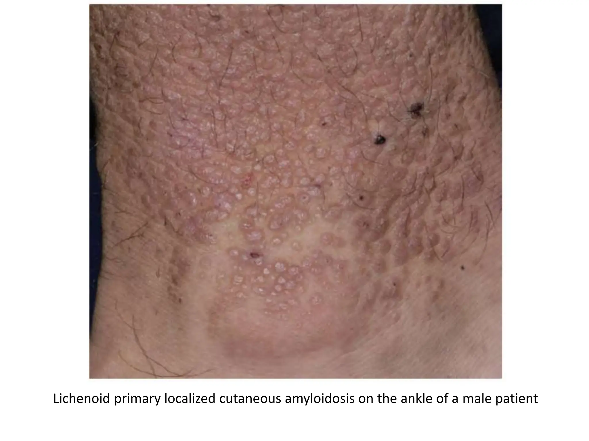 Cutaneous amyloidosis by dermatology resident.pptx