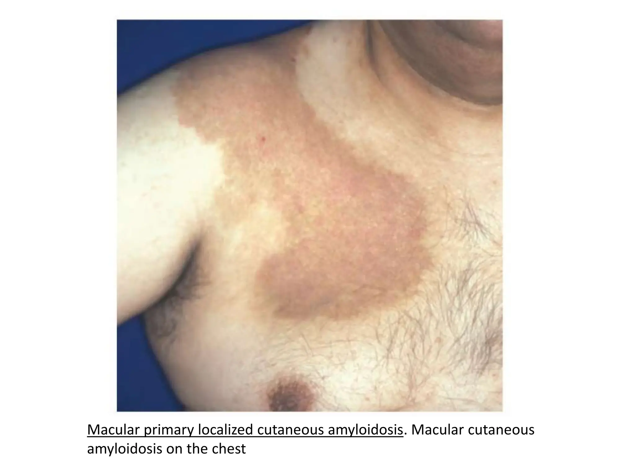 Cutaneous amyloidosis by dermatology resident.pptx