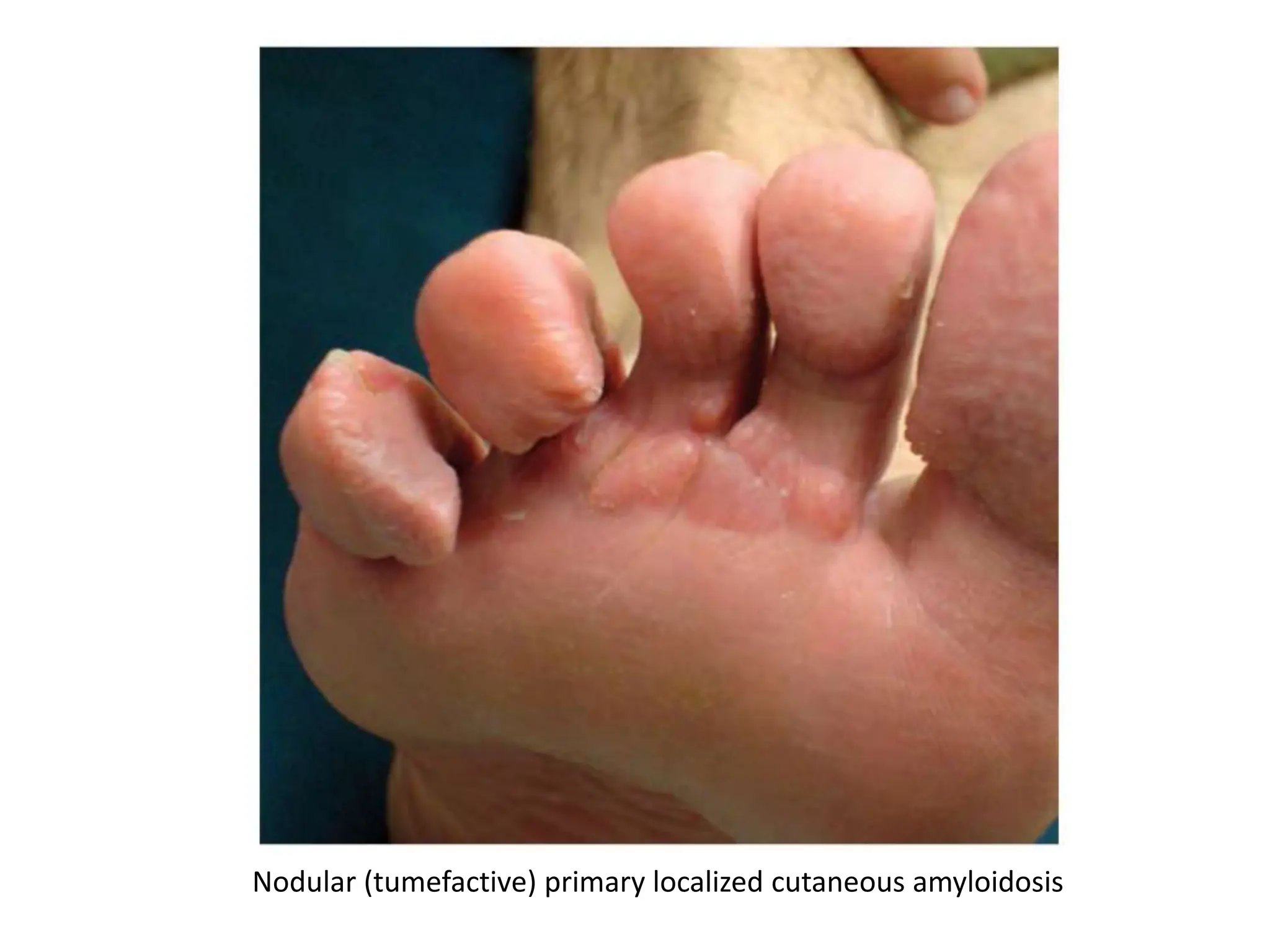 Cutaneous amyloidosis by dermatology resident.pptx