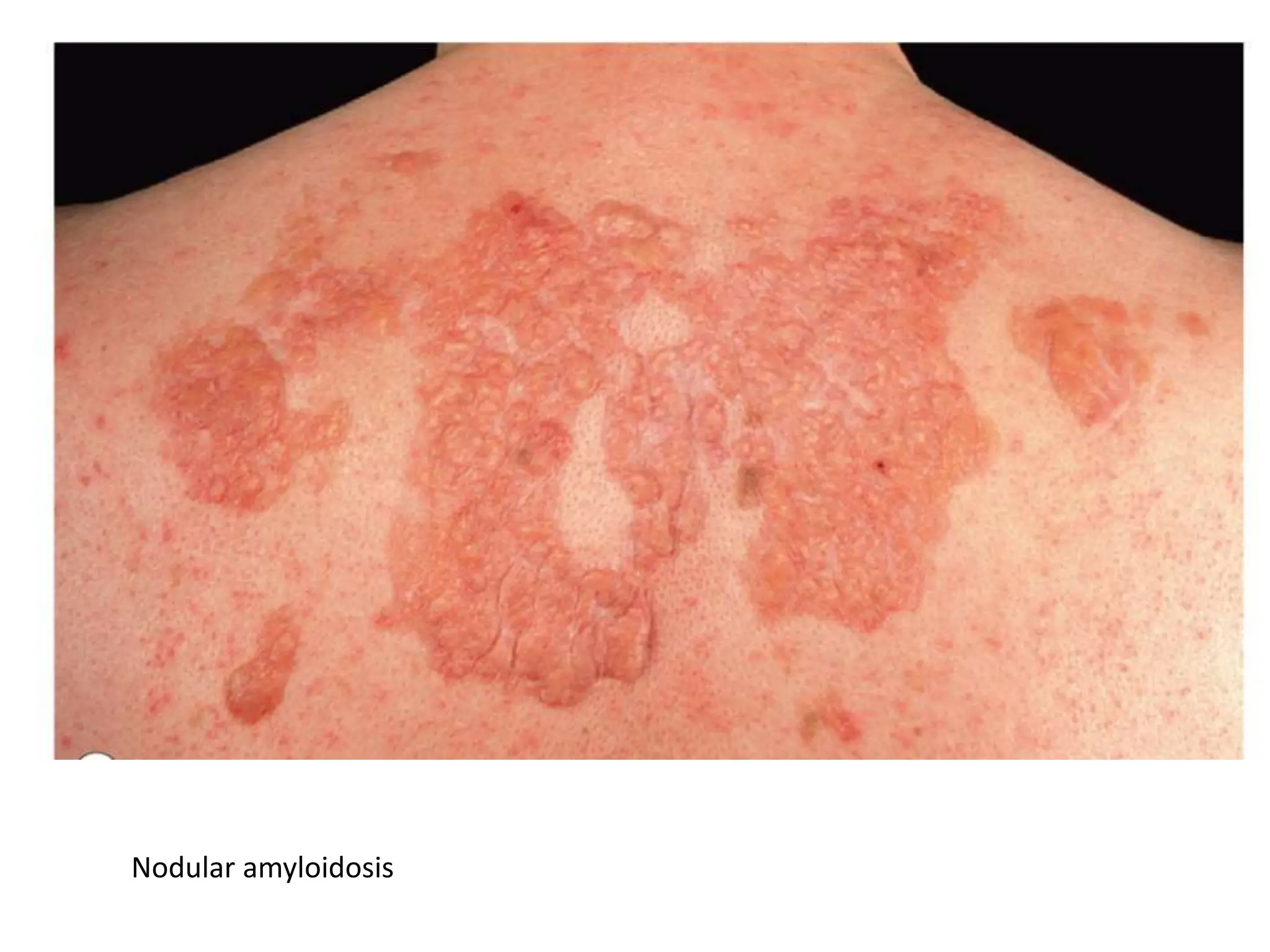 Cutaneous amyloidosis by dermatology resident.pptx