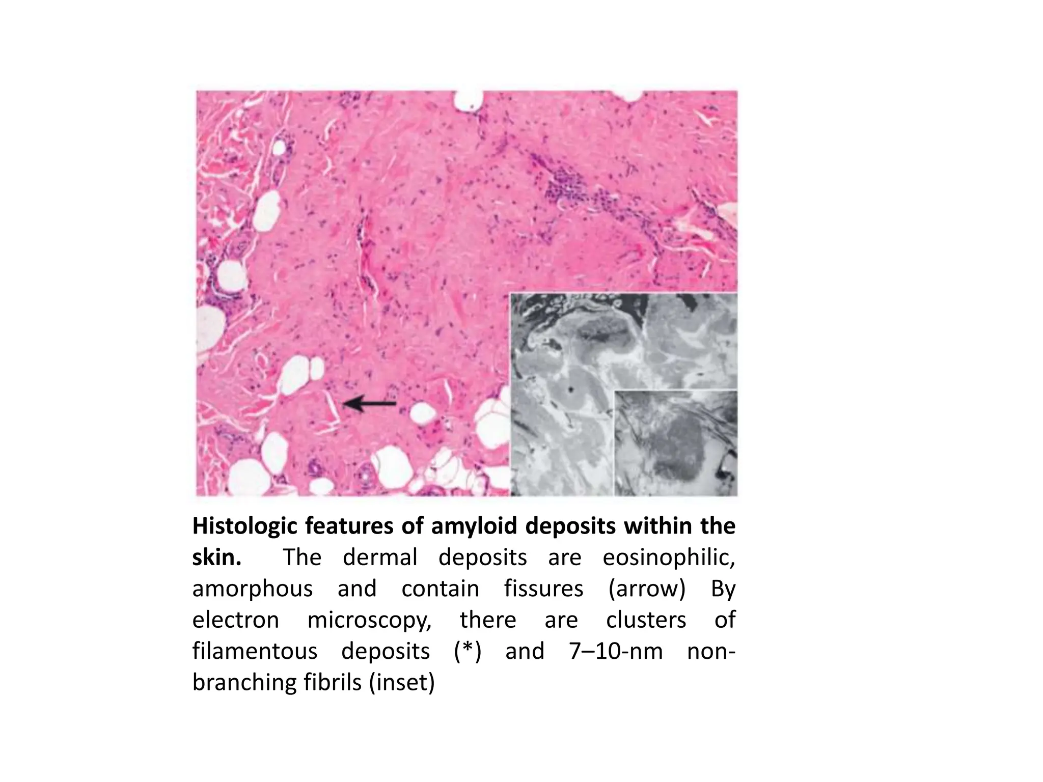 Cutaneous amyloidosis by dermatology resident.pptx
