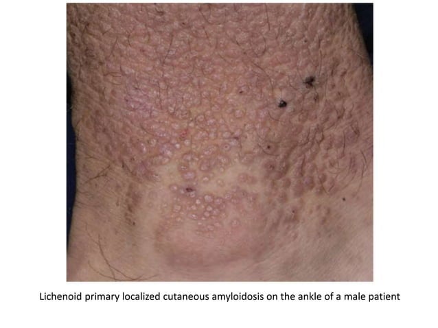 Cutaneous amyloidosis by dermatology resident.pptx | Blood Disorders ...