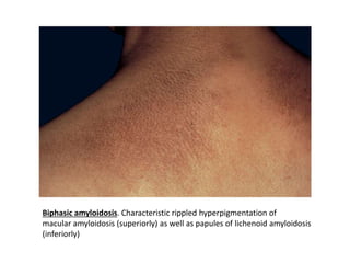Cutaneous amyloidosis by dermatology resident.pptx