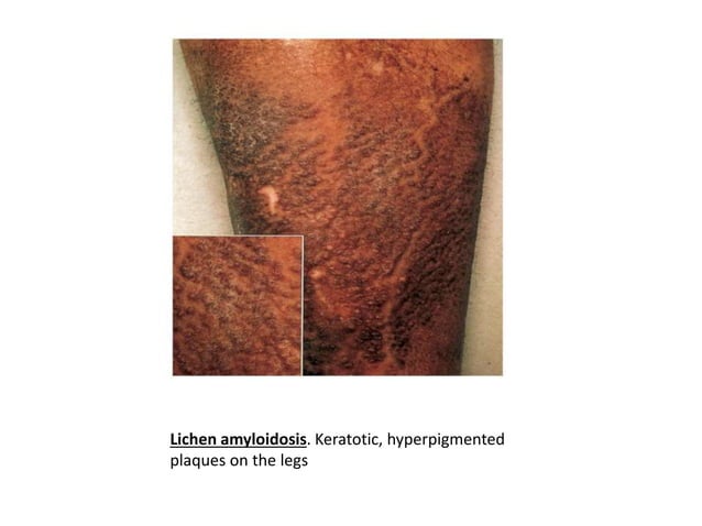 Cutaneous amyloidosis by dermatology resident.pptx | Blood Disorders ...