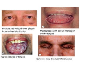 Cutaneous amyloidosis by dermatology resident.pptx