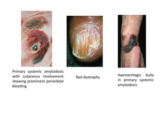 Cutaneous amyloidosis by dermatology resident.pptx