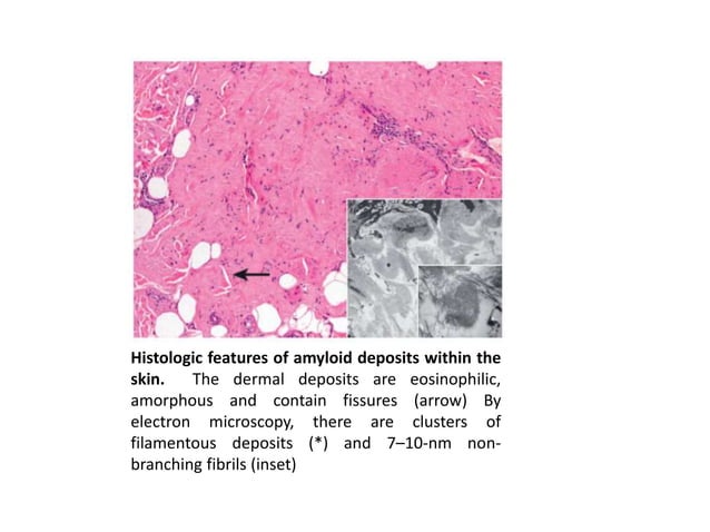 Cutaneous amyloidosis by dermatology resident.pptx | Blood Disorders ...