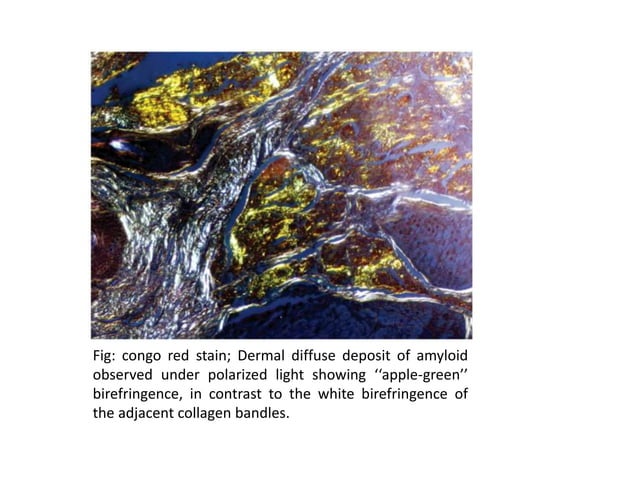 Cutaneous amyloidosis by dermatology resident.pptx | Blood Disorders ...