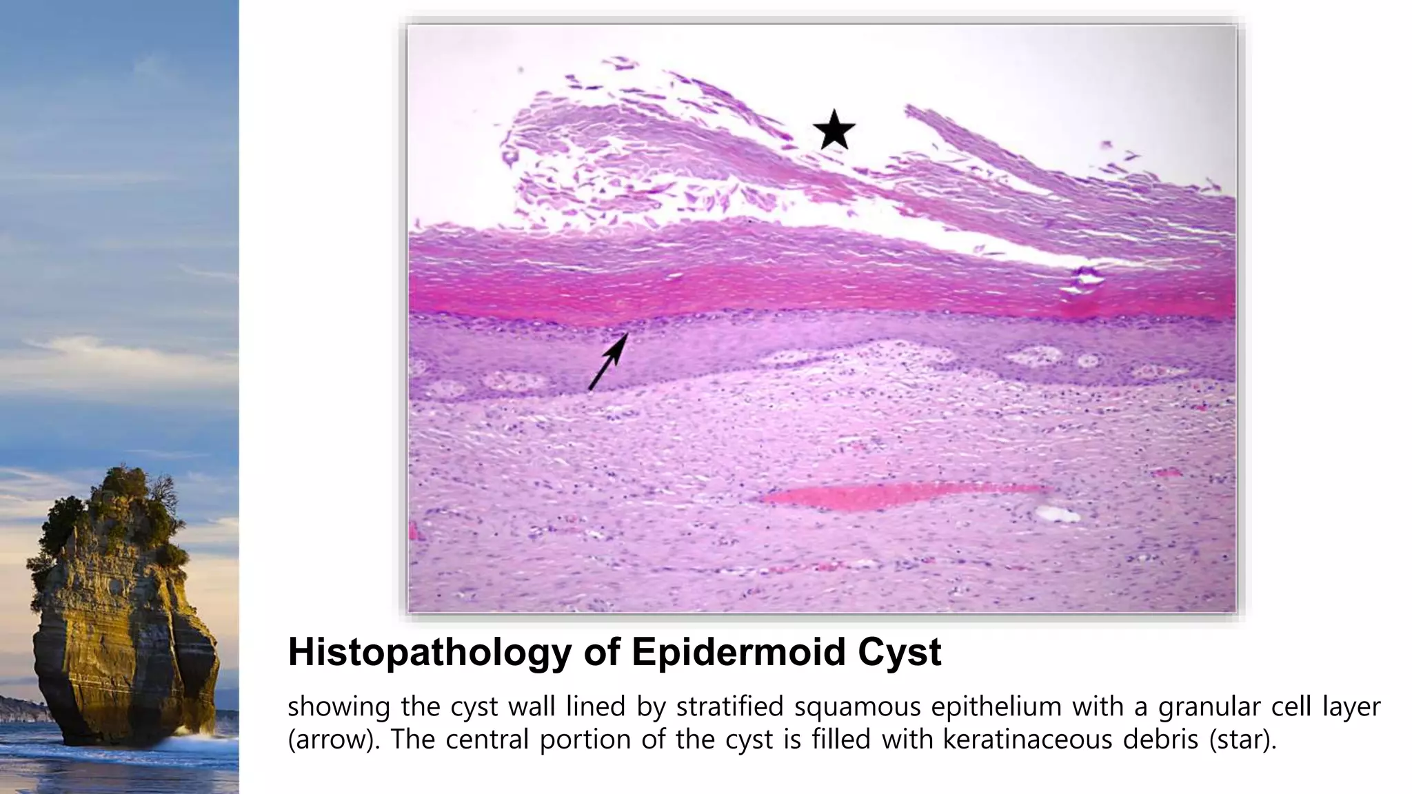 Cutaneous Cysts | PPTX
