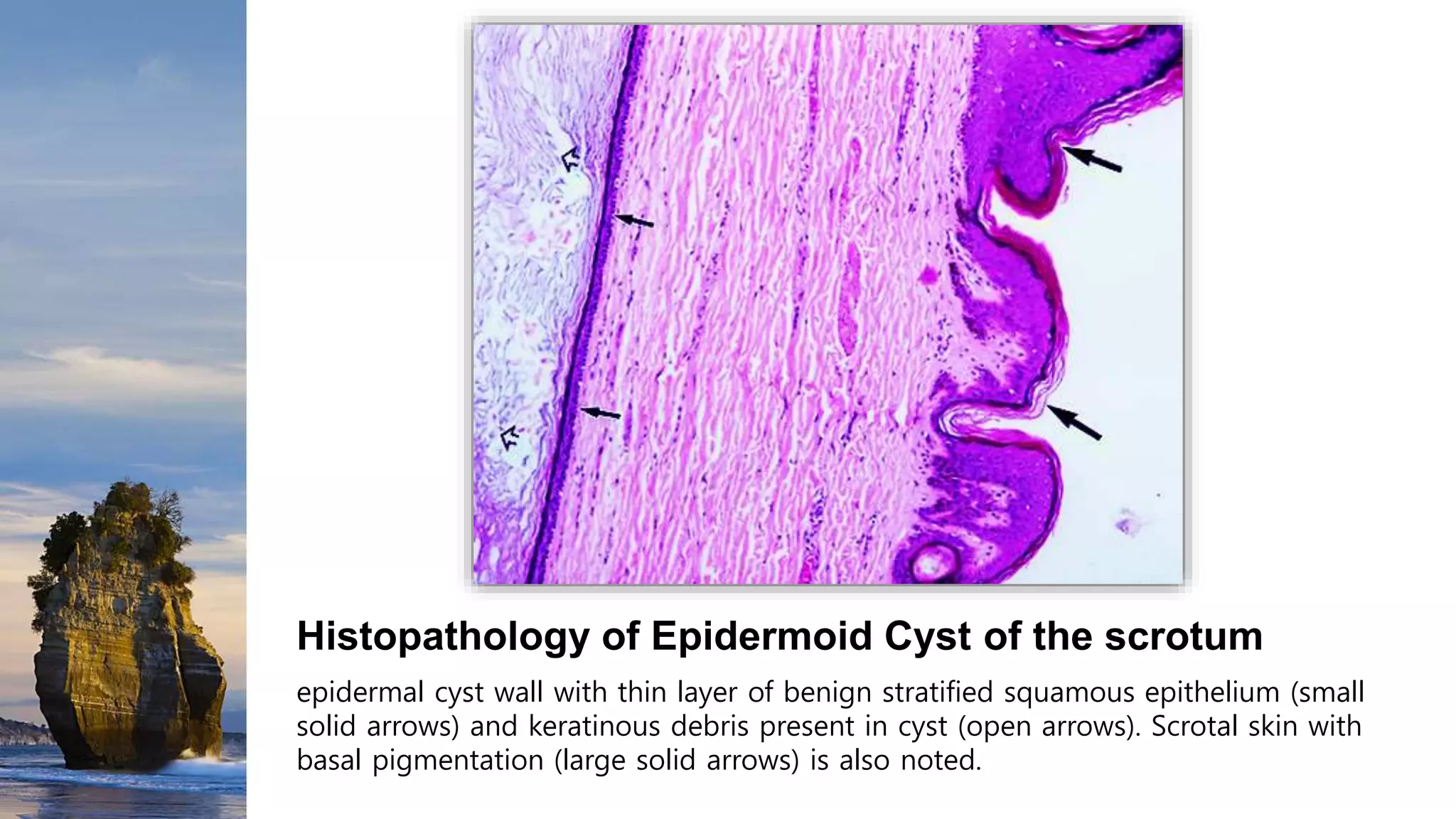 Cutaneous Cysts | PPTX