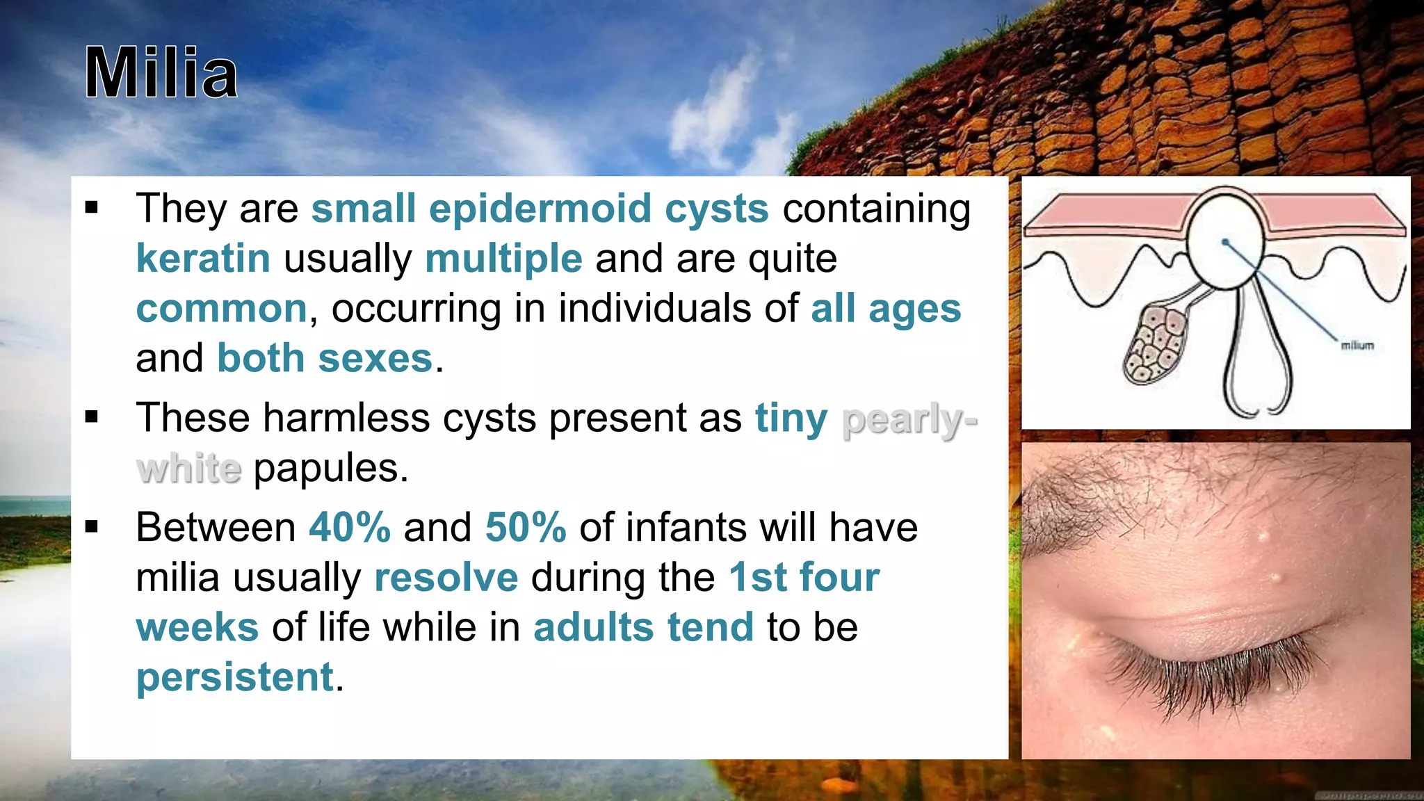 Cutaneous Cysts | PPTX